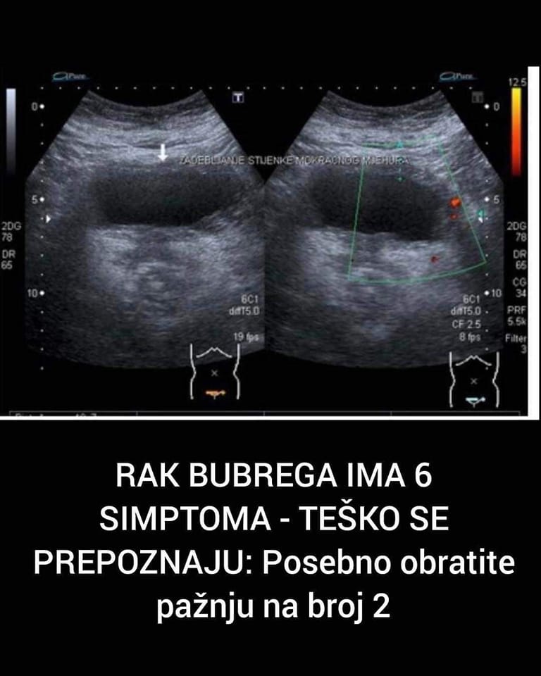 RAK BUBREGA IMA 6 SIMPTOMA – TEŠKO SE PREPOZNAJU: Posebno obratite ...